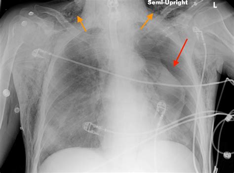 Keeping Patients Safe During Emergency Tracheostomy Management