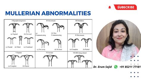 Mullerian Abnormalities Part 1 Dnb Theory Class Made Easy Dnb Obgyn