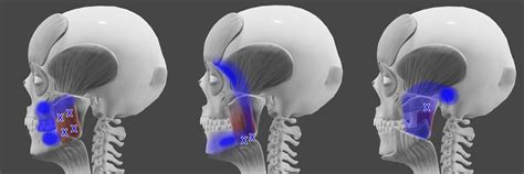 Masseter Trigger Points — Morningside Acupuncture Nyc
