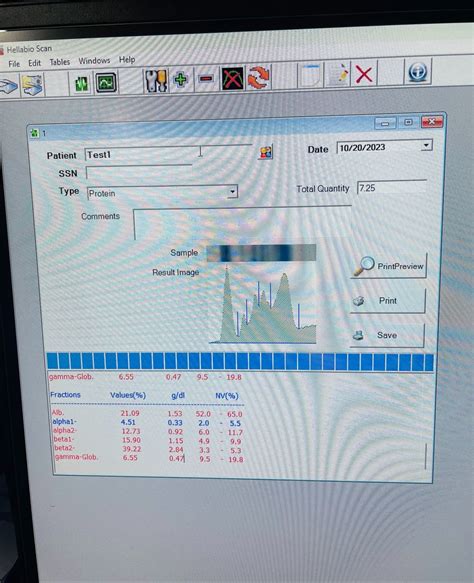 Proteinelectrophoresis Medicalscience Diagnostics Dr Joseph Musonda Chalwe