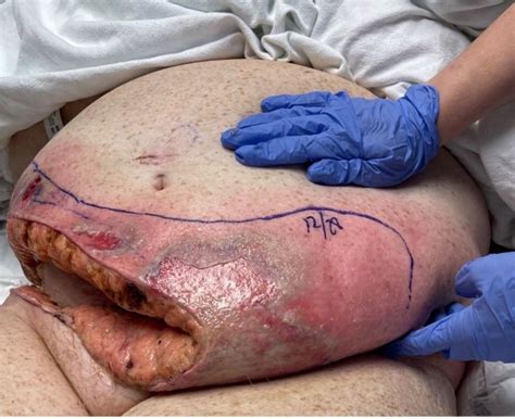 Pyoderma Gangrenosum Following Gynaecological Surgery Bmj Case Reports