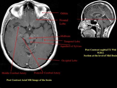 Normal Mri Brain