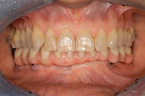 Successful Reversal Of A Circular Bone Defect Around A Posterior