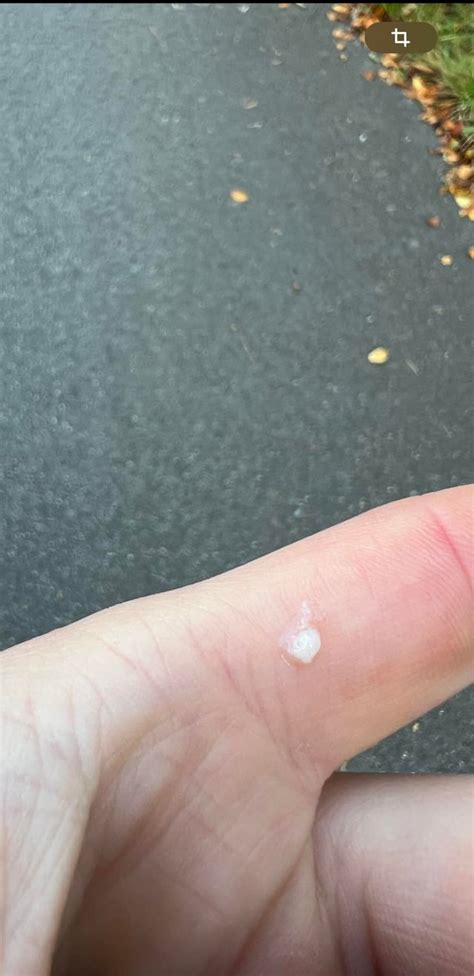 Thick White Glue Mucus From Nose R Sinusitis