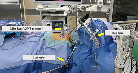 Experience With The Use Of Intraoperative Continuous Nerve Monitoring In Video‐assisted Neck
