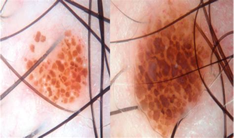 Dermoscopy An Update And Personal View The Pmfa Journal