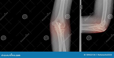 Left Elbow Olecranon Fracture At Aileen Markham Blog