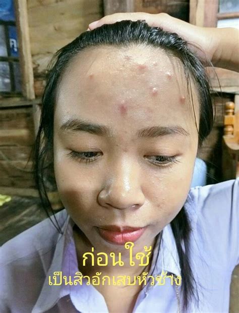 เจอปัญหาเหลานี พบวิธีลด ฝ้า กระ จุดด่างดำ สิวอักเสบรุนแรง