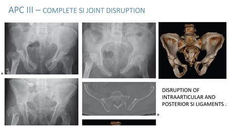 Pelvic Ring Fractures Ppt