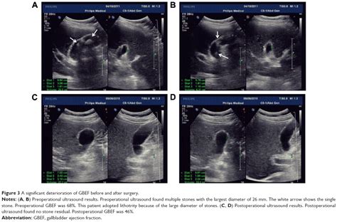 Risk Factors For Gallbladder Contractility After Cholecystolithotomy I