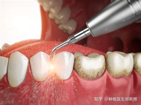 几十元的洗牙和上千元的洗牙大有不同，建议要洗牙的都了解清楚 知乎