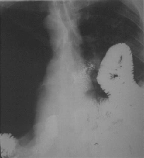 Jejunal Loop Herniation In The Chest After A Cardia Resection