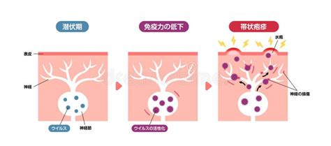 Mecanismo De Ilustración Vectorial De Herpes Zóster Ilustración del