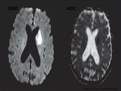 ppt diffusion tensor imaging powerpoint presentation free download