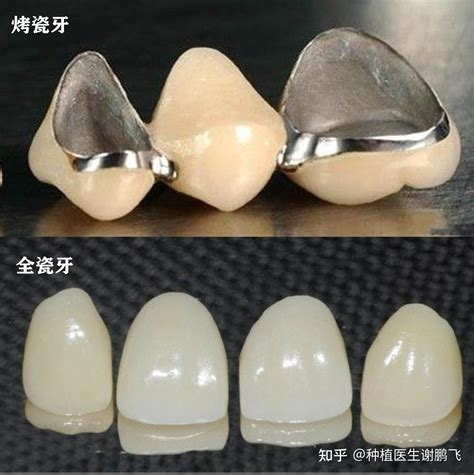 医生，我做了全瓷牙，请问它能用多久？ 知乎