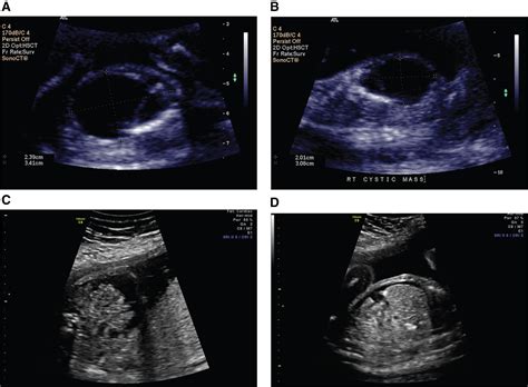 Congenital Cmv Calcifications