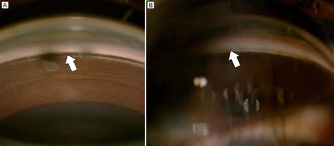 A Gonioscopy Of The Right Eye Showing 4 Posterior Trabecular Meshwork