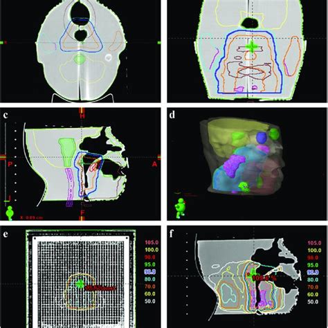 Pdf Feasibility Of A 3d Printed Anthropomorphic Patient Specific Head