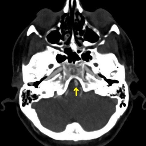 Basilar Artery Fenestration An Incidental Finding In A Patient With Headache Eurorad