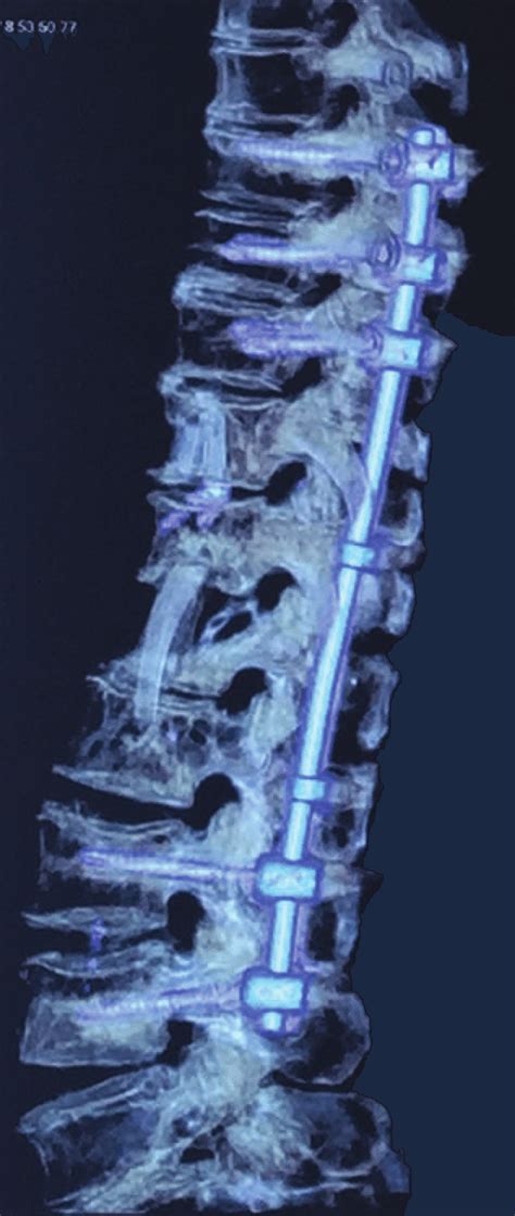 Postoperative 3d Ct Images After Anterior Debridement L1 Corpectomy Download Scientific