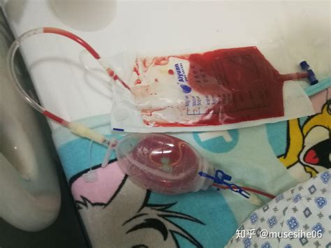 记录我的臀肌挛缩手术 知乎