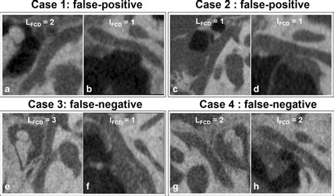 Four Misdiagnosed Cases Using Fcd Scoring Method Among Which 2 Are