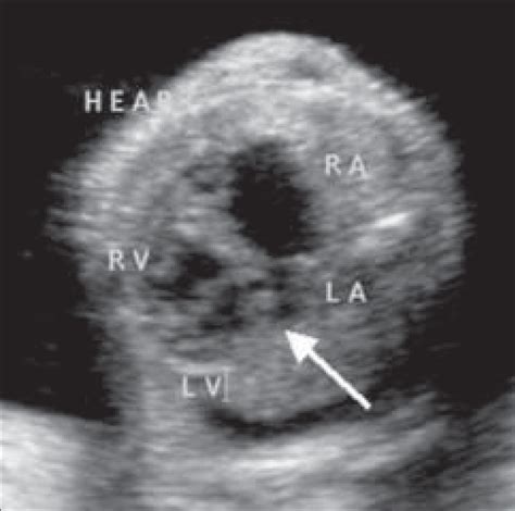 Altered Cardiac Axis Left Axis Deviation Of The Heart Is Seen Arrow Download Scientific