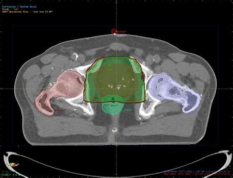 The Axial Section Of Dose Distribution For Compensator Based Imrt A Download Scientific