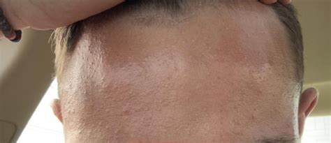 Small Forehead Bumps Rdermatologyquestions
