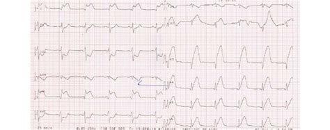 Electrocardiographic Ecg Finding Of St Elevation Myocardial