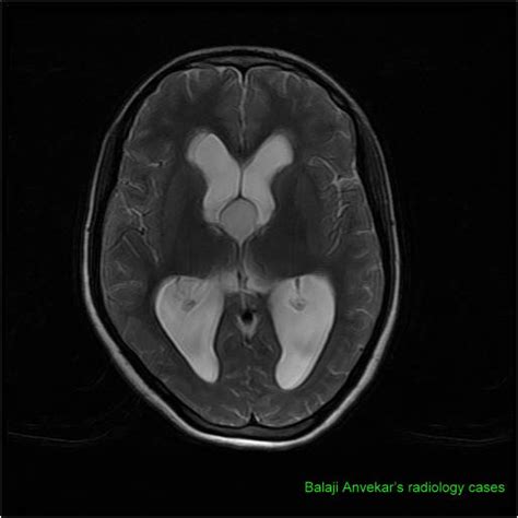 Dr Balaji Anvekar Frcr Colloid Cyst Mri