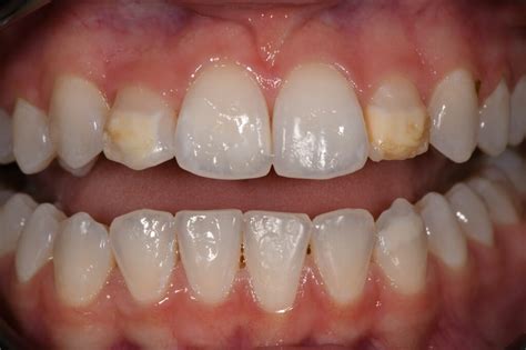 Resin Infiltration And Composite Layering