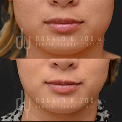 How Many Units Of Botox Does It Take To Reduce A Masseter Beverly