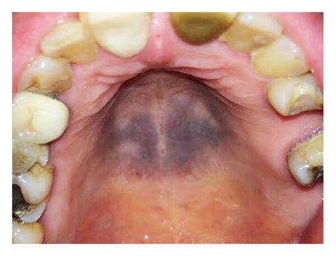 Smokers Palate Histology