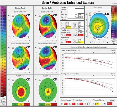 Right Eye Pentacam Belin Ambrosio Enhanced Ectasia Display Map Showing
