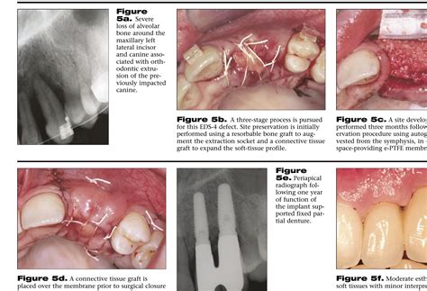 Figure 16 Extraction Defect Assessment Classification
