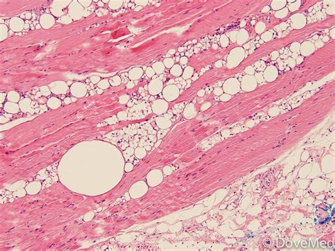 Pelvic Lipomatosis