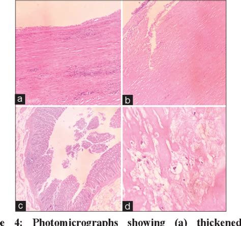 Figure 1 From Giant Mucocele Of The Appendix Laparoscopic Management A Case Report And Review