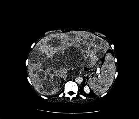 Ct Scan Of The Abdomen Significantly Enlarged Liver With Irregular