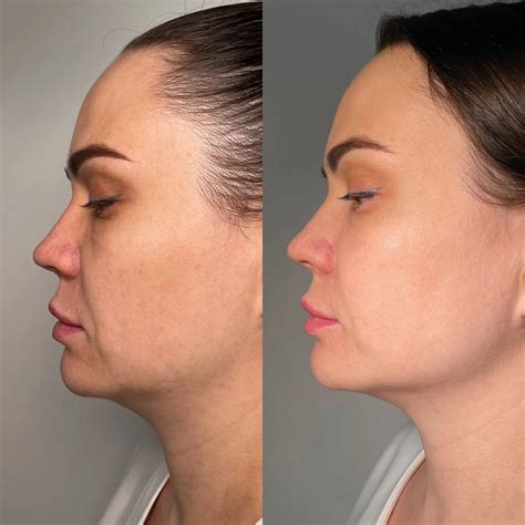 Морфеус 8 аппарат процедура отзывы и цена на игольчатый Rf лифтинг Inmode Morpheus