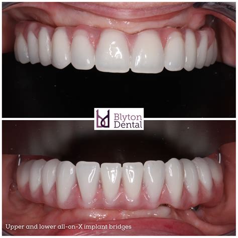 Upper And Lower All On X Implant Bridges — Blyton Dental