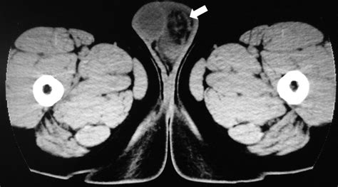 Noninfectious Funiculitis Journal Of Emergency Medicine