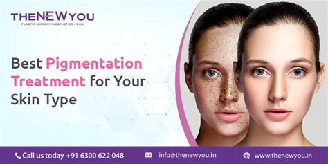 Right Pigmentation Treatment The New You Clinic Thenewyou