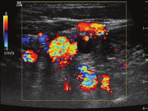 Transverse Color Doppler Image Demonstrates Prominent Cervical Venous