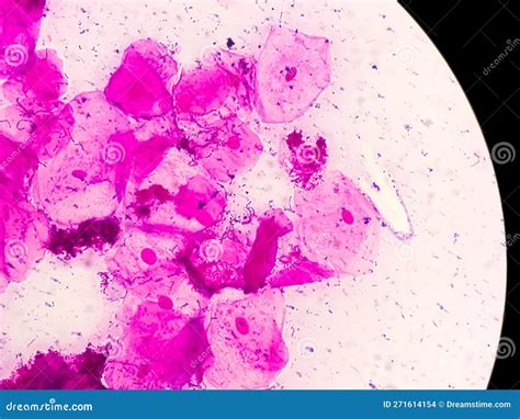 Microscopic Close View Of High Vaginal Swab Bacterial Vaginosis Bv
