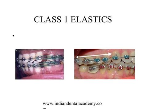 Class I Elastics