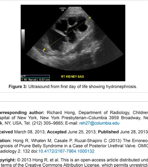 Figure 1 From The Erroneous Diagnosis Of Prune Belly Syndrome In A Case