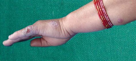 Nodulo Ulcerative Lesions Along The Lymphatics Over The Hand And