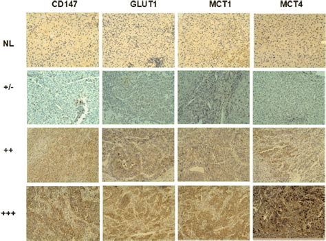 CD147 expression in tumorous tissues obtained from patients with HCC is ...