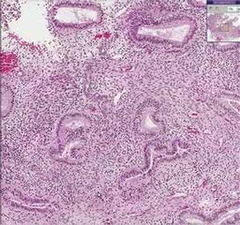 Histopathology Uterus Endometrium Secretory Endometrium YouTube